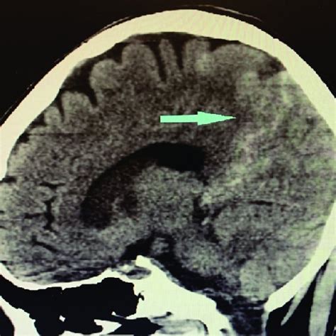 Sagittal Image Of Brain Ct Showing Subarachnoid Hemorrhage Blue Download Scientific Diagram