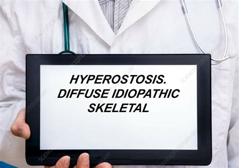 Hyperostosis Conceptual Image Stock Image F0371412 Science