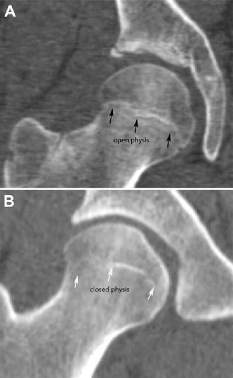 Figure 2 From Reference Values For Proximal Femoral Anatomy In Adolescents Based On Sex Physis