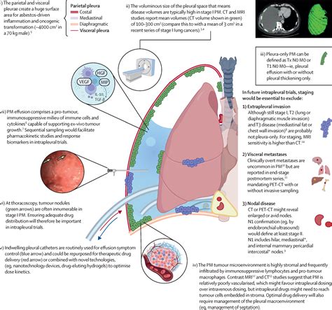 Intrapleural Space Diagram
