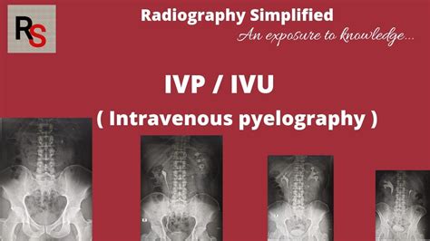Ivp Ll Intravenous Pyelography Ll Intravenous Urography Ll Radiography Simplified Ll Youtube