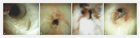 Biliary Strictures Identified As Benign And Suspicious For Malignancy Download Scientific