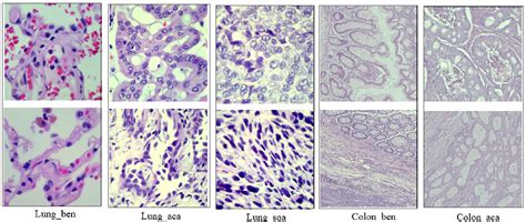 Figure 1 From Classification Of Lung And Colon Cancer Histopathological Images Using Global