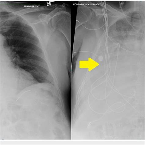 Chest X Ray Demonstrating The Dobhoff Tube Penetrating The Right Lung Download Scientific