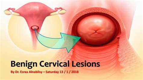 Benign Cervical Lesions Ppt