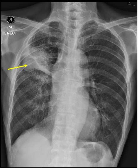 Non Small Cell Lung Cancer Adenocarcinoma Radiology Cases