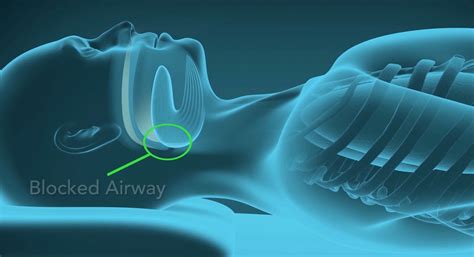 Implanted Sleep Apnea Device Promises Safer Uninterrupted Sleep