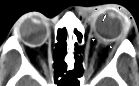 Ct In The Evaluation Of Acute Injuries Of The Anterior Eye Segment Ajr