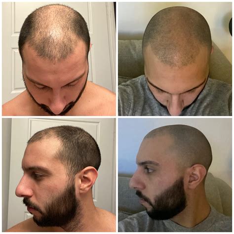 Buzz Cut Hair Loss At Margaret Burgin Blog