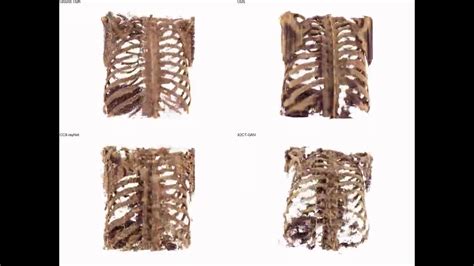 unaligned 2d to 3d translation with conditional vector quantized code diffusion using