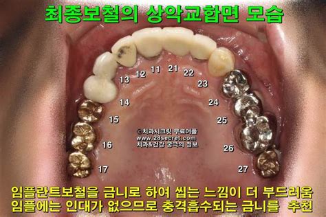 치과시크릿 건강시크릿 자기계발시크릿 상악동거상술 임플란트 즉시기능임플란트 4부