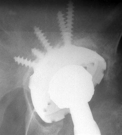 Acetabular Loosening Around Entire Cup Figure 4 Revision To A Cemented