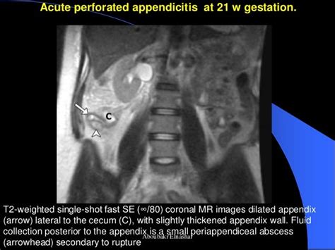 Appendicitis During Pregnancy