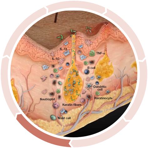 Hidradenitis Suppurativa Hs Causes And Inflammation