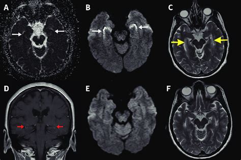 Serial Magnetic Resonance Imaging Mri In Opioid Associated Amnestic Download Scientific