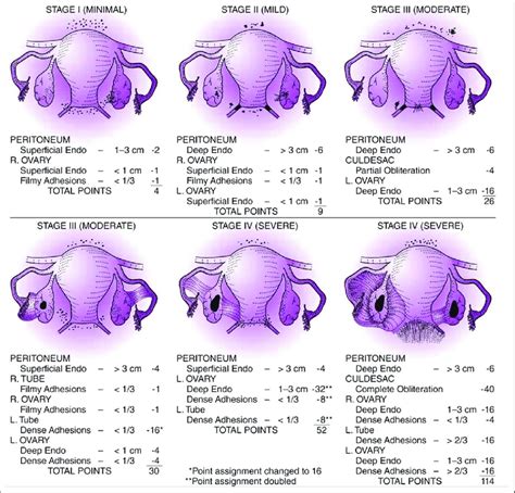 Stages Of Endometriosis Source Download Scientific Diagram