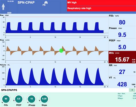 Ventilation Modes Neuroresus
