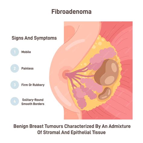 Premium Vector Fibroadenoma Neoplasm In Female Chest Benign Breast Tumour