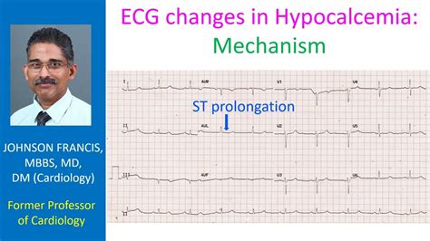 Hypercalcemia And Qt Interval What You Need To Know Eresources Blog