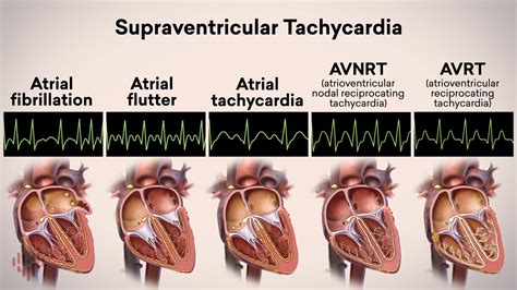 Atrial Flutter Heart Condition