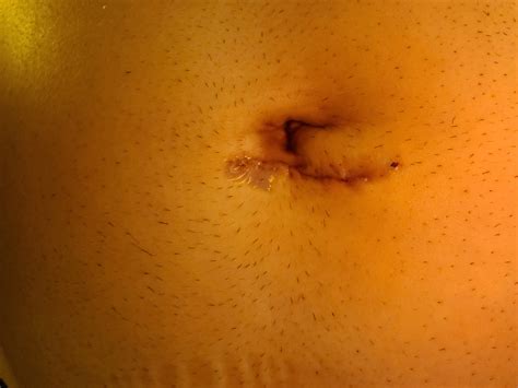 Umbilical Hernia Repair 2023 Rscars
