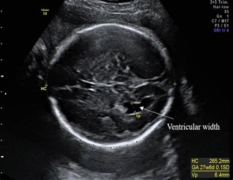 Example Of A Posterior Va Measurement In A Week Plus Day Old Download Scientific Diagram