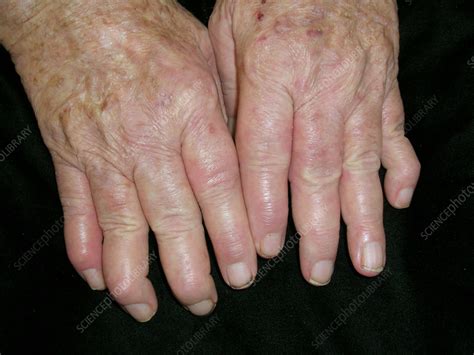 Rheumatoid Arthritis Nodules Stock Image C056 5085 Science Photo Library