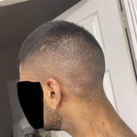 Scalp Folliculitis R Folliculitis