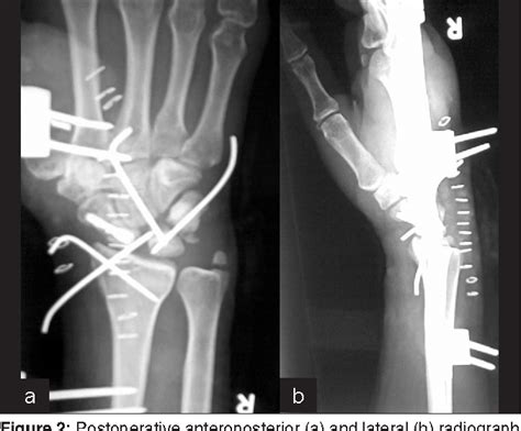Carpal Dislocation Semantic Scholar