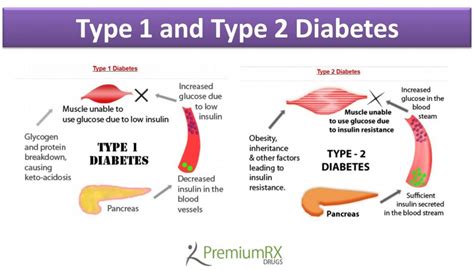 Difference Between Type 1 And Type 2 Diabetes Premiumrxdrugs Online