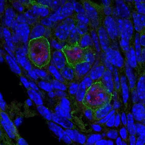 Brca1 Mutation Linked To Higher Infertility Risk Study Mirage News