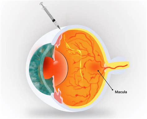 Intravitreal Injections Dr James English Ophthalmologist And Ophthalmic Surgeon Brisbane QLD