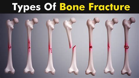 Compound Bone Fracture
