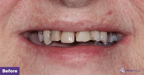 Ritas Smile Makeover In Bacchus Marsh Sunbury Dental House
