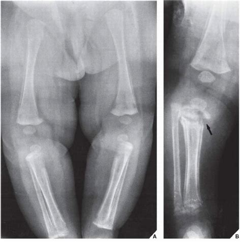 Osteomyelitis Infectious Arthritis And Soft Tissue Infections