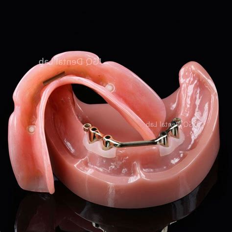 Selling Cast Precision Attachment Partial Framework Denture Removable Restoration China Dental