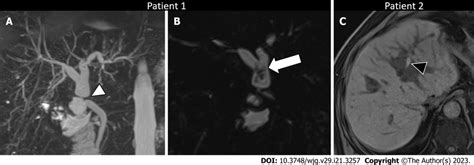 Biliary Sludge And Biliary Cast A Patient With Biliary Sludge And