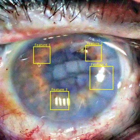 Post Mortem Iris Decomposition And Its Dynamics In Morgue Conditions