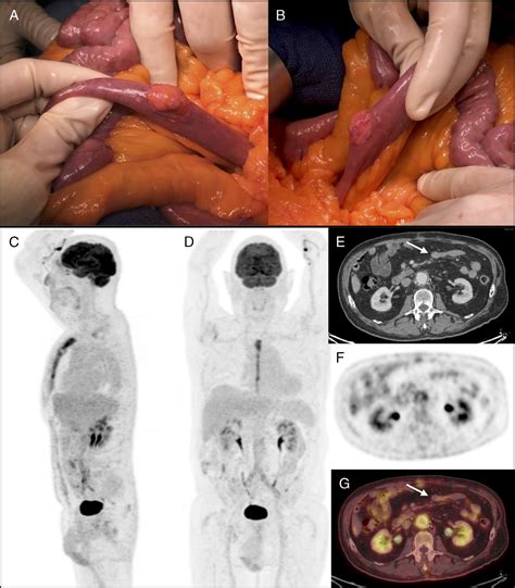 Diagnosis Of Ectopic Pancreas In Small Intestine With 18f Do