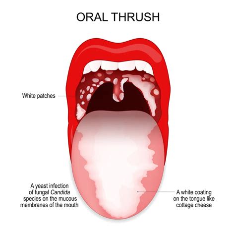 Medications And Oral Health Newmouth