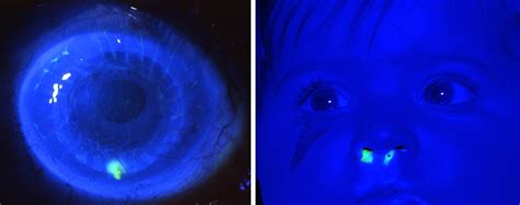 Fundamentals Of Fluorescein Eye Pix