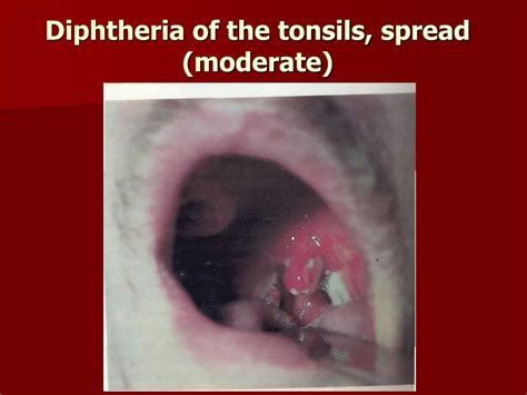 Ppt Infectious Diseases With Tonsillitis Diphtheria Powerpoint