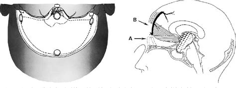 Figure 2 From Bifrontal Basal Interhemispheric Approach To Craniopharyngioma Resection With Or