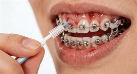 6 Powerful Benefits Of Interdental Brushes For Braces