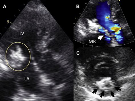 Transthoracic Echocardiography Shows Caseous Calcification Of The Download Scientific Diagram