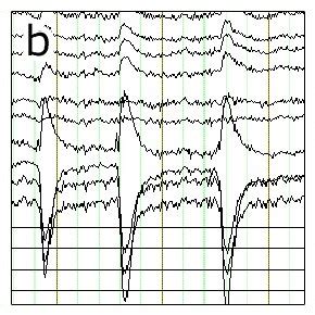 PDF Automated Artifact Detection In BrainStream An Evaluation Of An Online Eye And Muscle