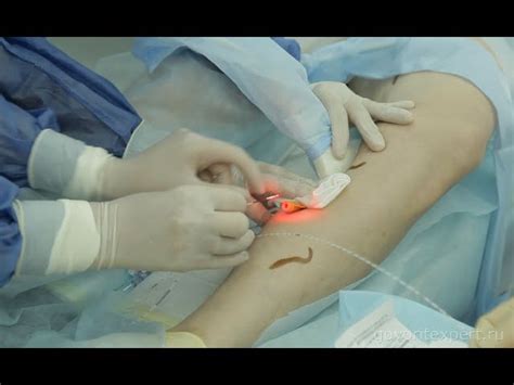 Лечение варикоза лазером показания и противопоказания этапы проведения