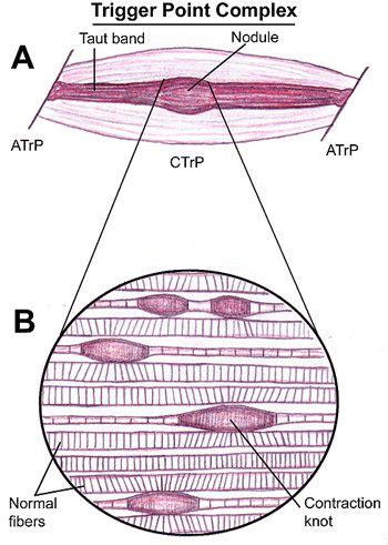 Painful Muscle Knots Trigger Points And Relief
