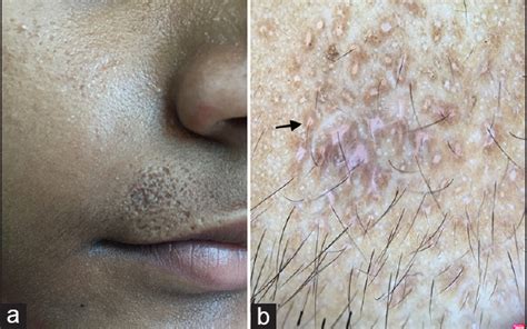 Dermoscopic Features Of Atrophoderma Vermiculatum Differentiation From Its Clinical Look Alike