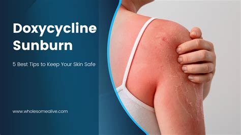Doxycycline Sunburn 5 Best Tips To Keep Your Skin Safe While Using Doxycycline